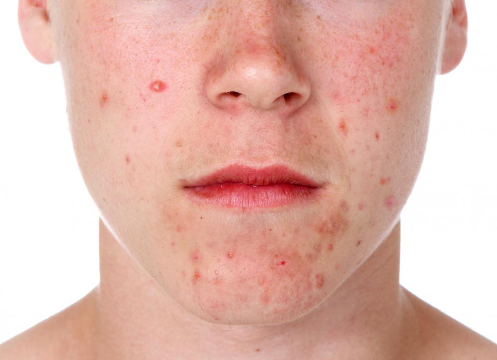 What Is the Connection between Dandruff and Acne?