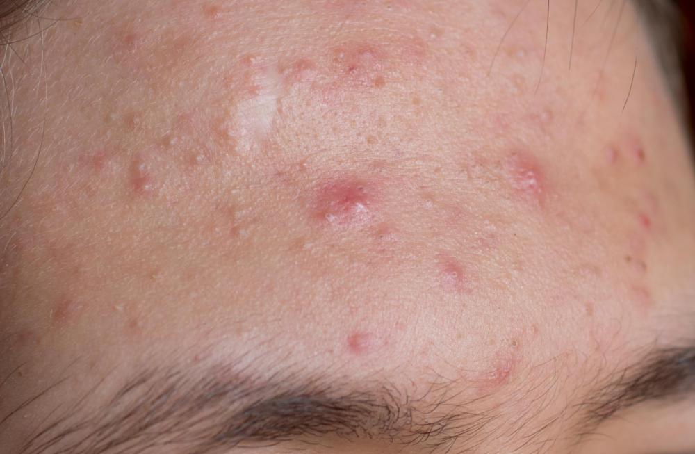 What is the T-Zone? (with pictures)