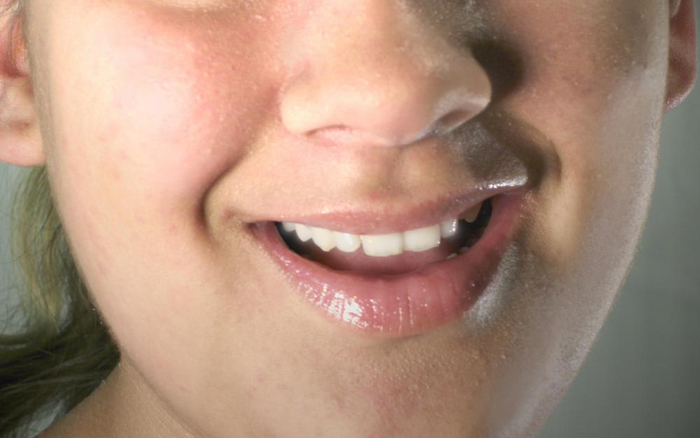 What is Lip Plumping? (with pictures)