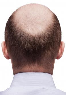 What are Hair Growth Patterns? (with pictures)